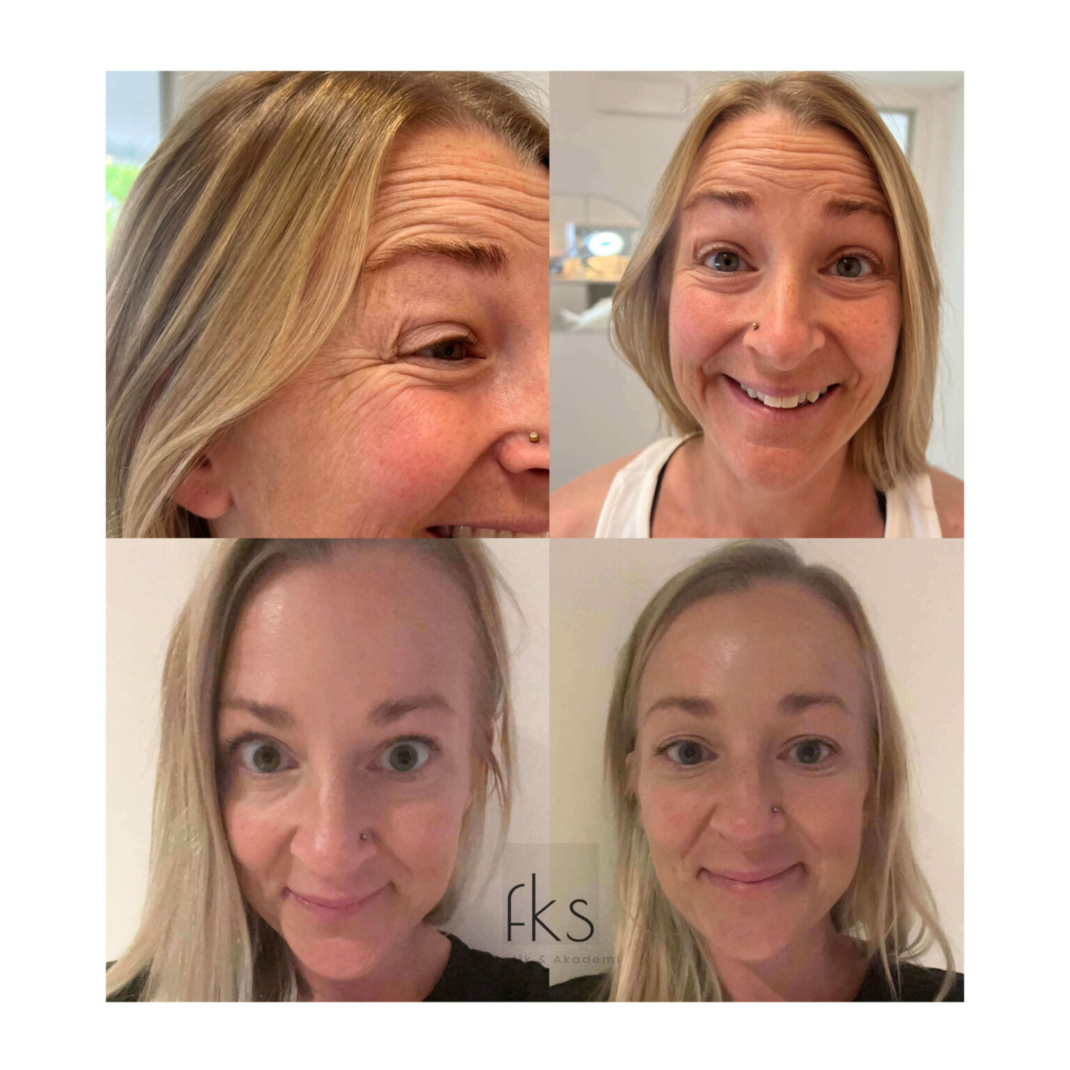 Botox | FKS Estetik & Akademi